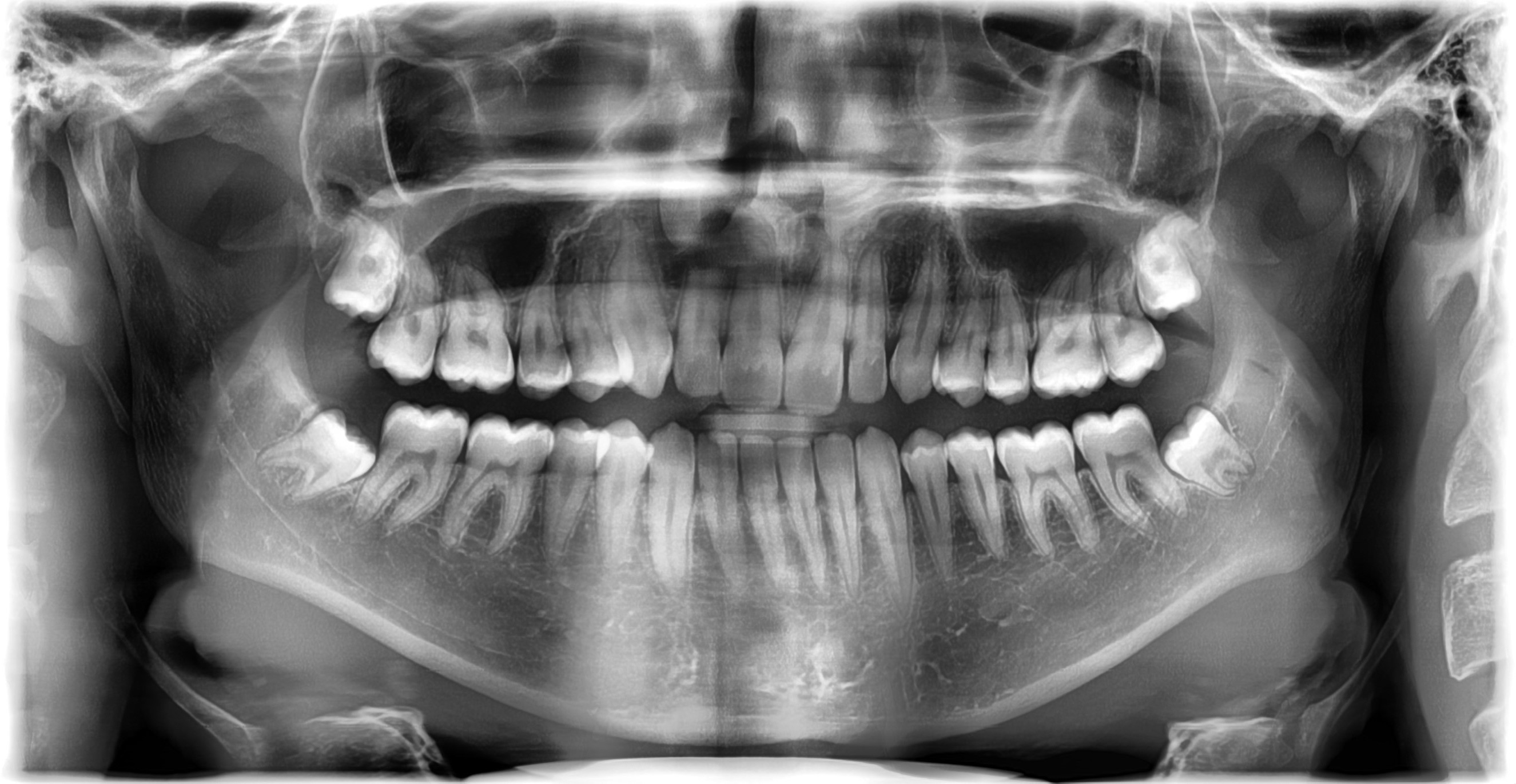 Verstandskiezen verwijderen? | Tandarts.nl Forum
